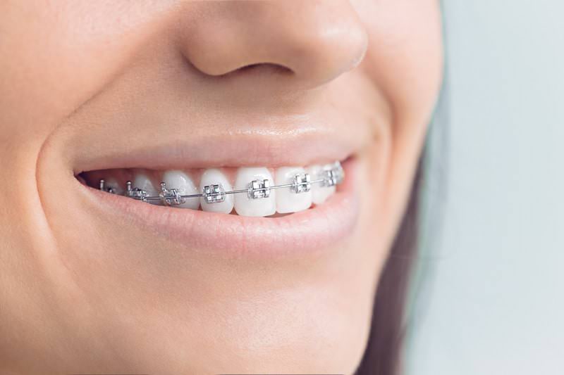 Affordable braces store