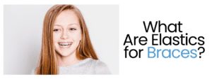 What Are Elastics for Braces? - Bubon Orthodontics